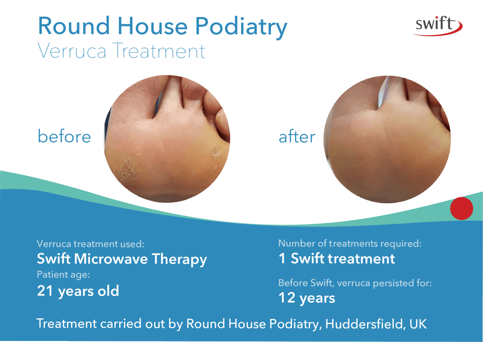 Swift Microwave Treatment For Verrucas | Round House Podiatry