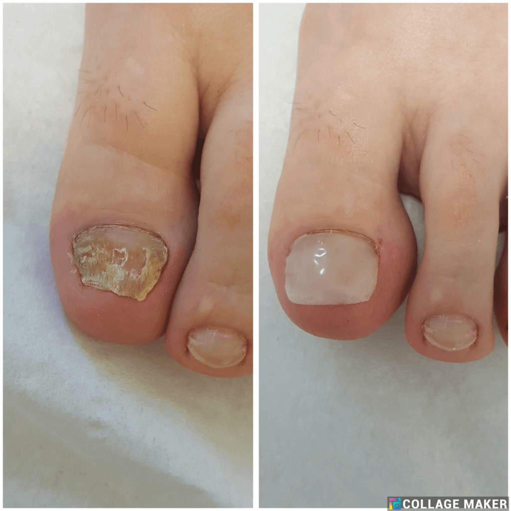 Toenail Reconstruction | Round House Podiatry